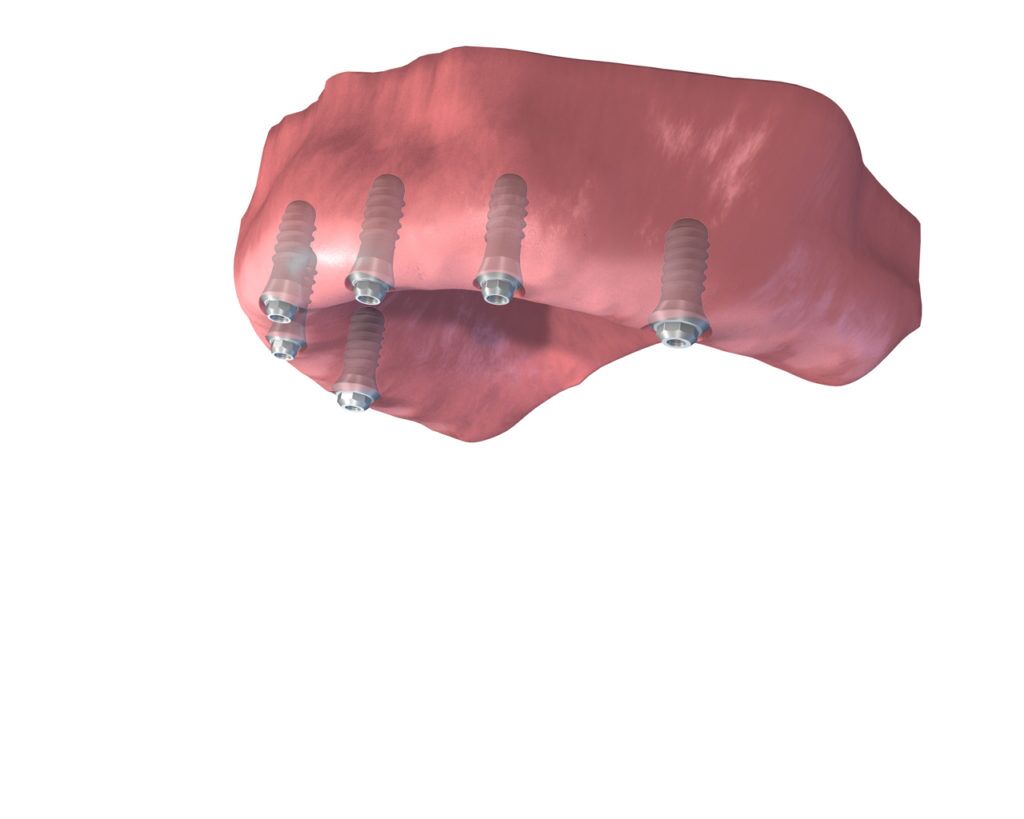 Implant Fixed Complete Dentures - New Smile Prosthodontics