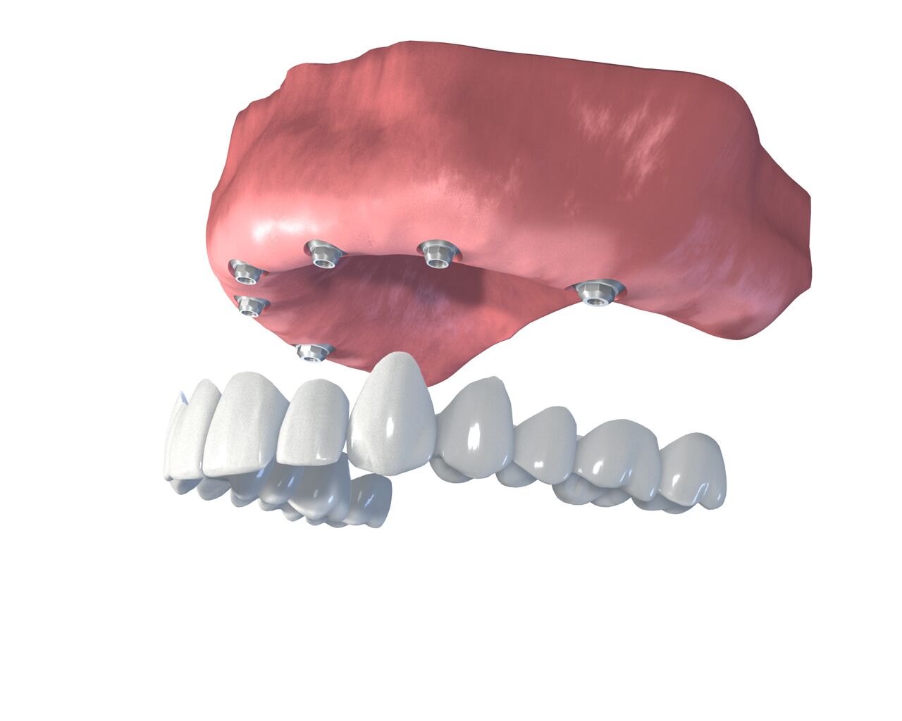 Implant Fixed Complete Dentures - New Smile Prosthodontics