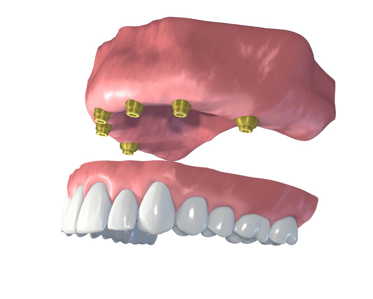 Implant Fixed Complete Dentures - New Smile Prosthodontics