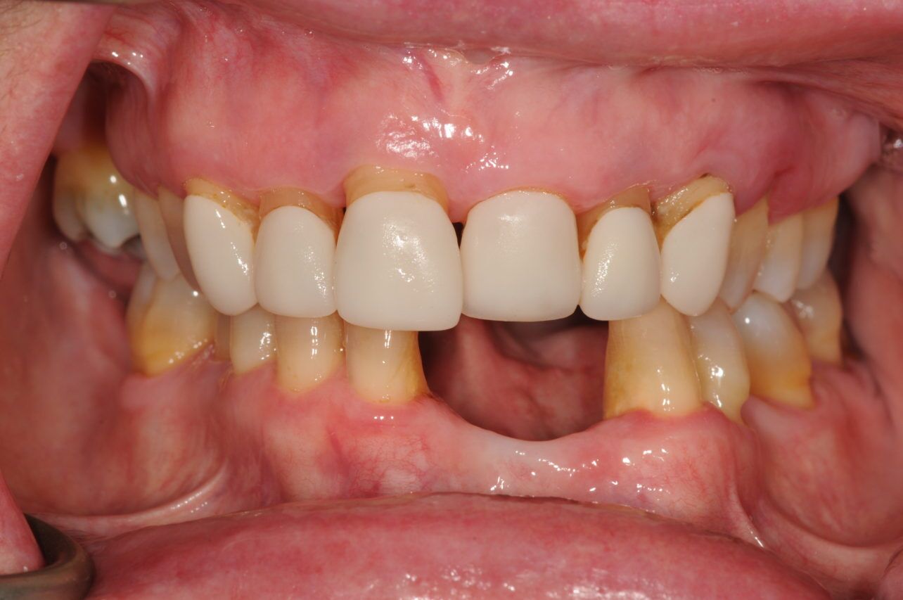 Living with Periodontal Disease & How It Made Me Feel