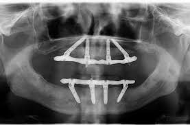 Straight vs Angled Dental Implant Placement? - New Smile Prosthodontics