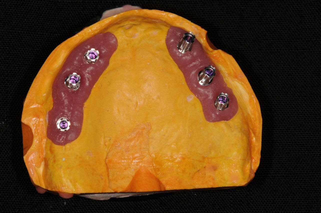 Straight vs Angled Dental Implant Placement? - New Smile Prosthodontics